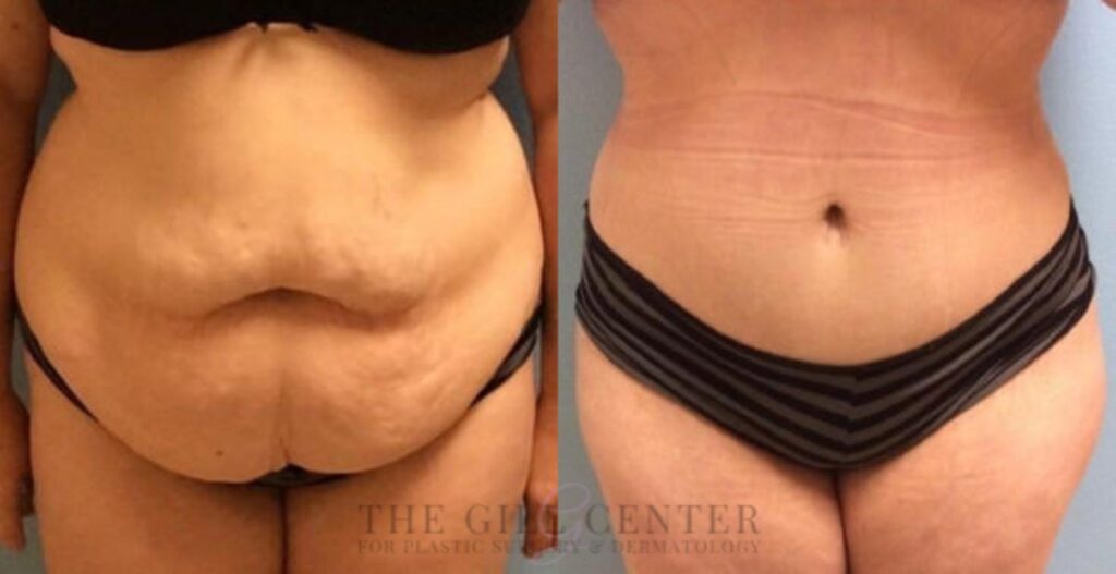Transforming Your Body Through Plastic Surgery Plasticsurgerygoal